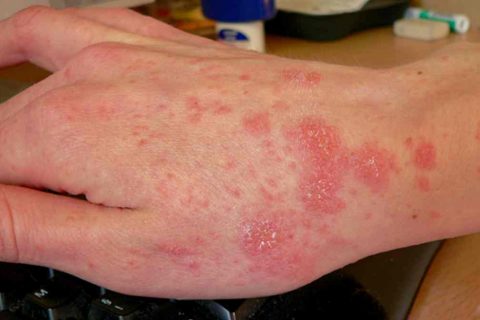 How To Cure Omphalitis In Adults